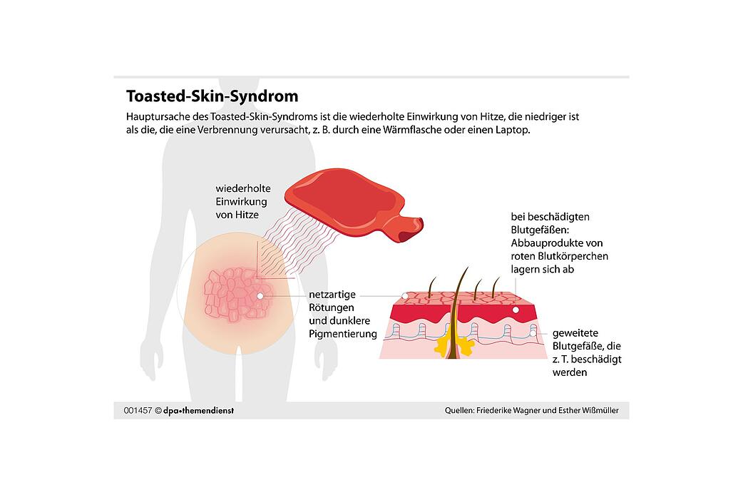 Wenn die Wärmflasche Hautprobleme macht - STIMME.de